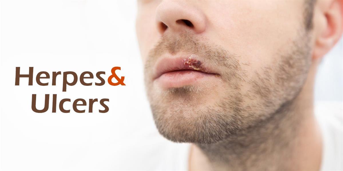 Herpes & Ulcers - Life Care Pharmacy - Online Pharmacy - Kuwait